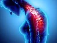 Kyfose: Årsager, symptomer og behandling - Hvorfor gå og have ondt